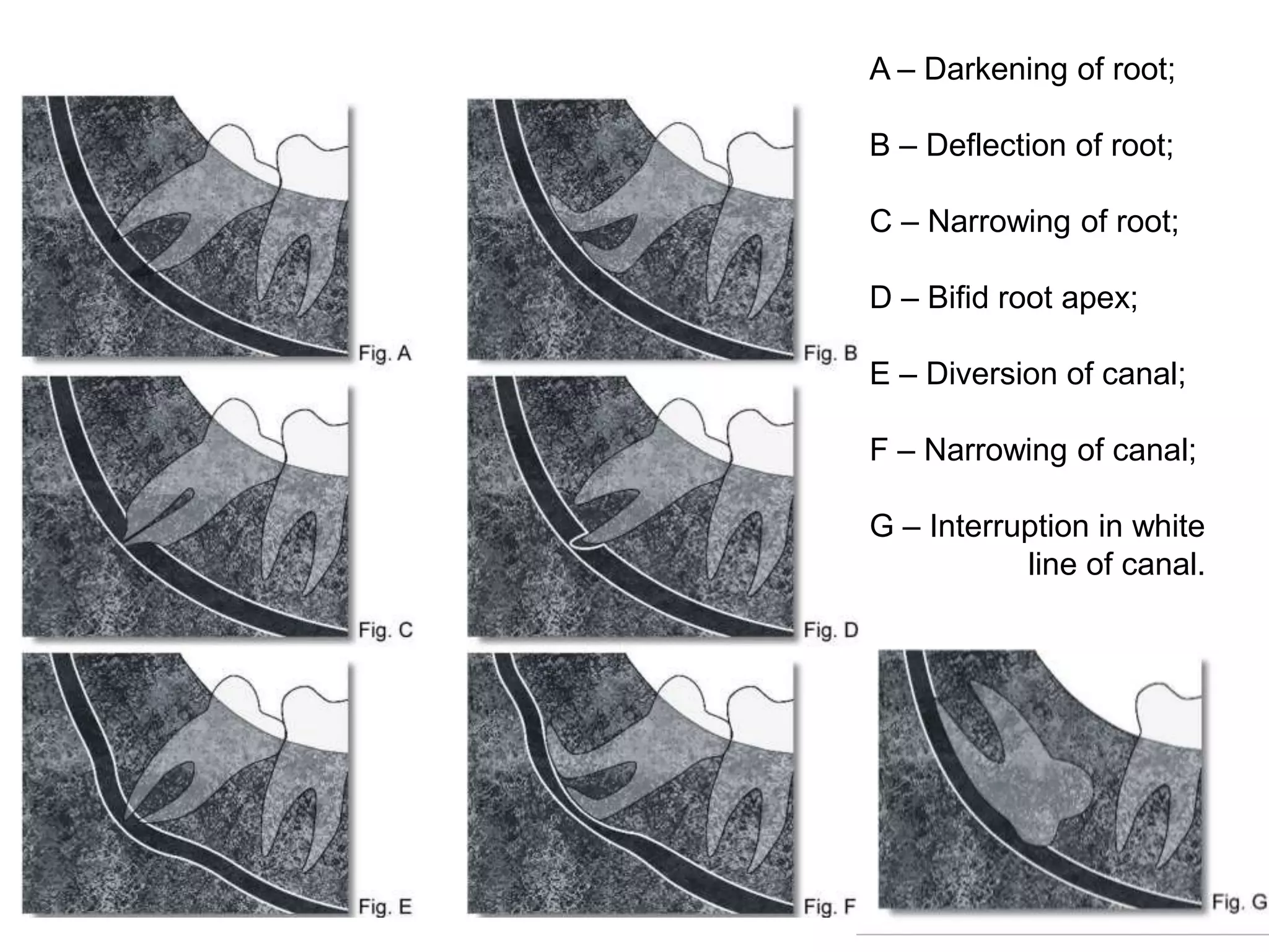 inferior alveolar nerve in opg | PPTX
