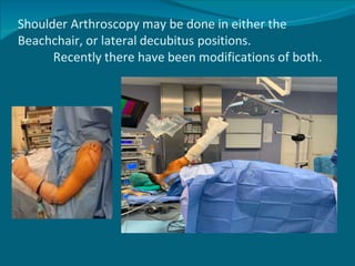 Shoulder Arthroscopy positioning and preparation | PPTX