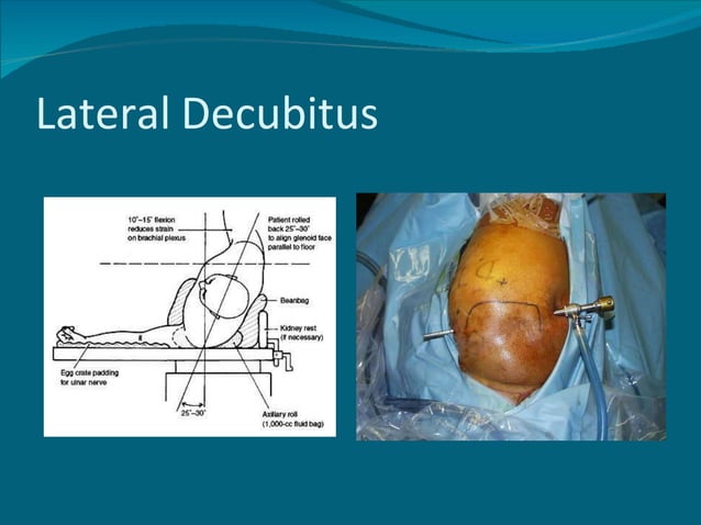 Shoulder Arthroscopy positioning and preparation | PPTX