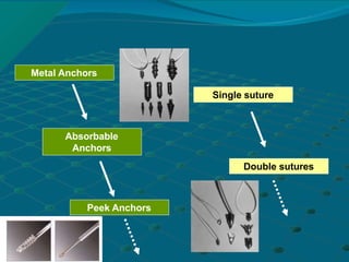 Shoulder Arthroscopy positioning and preparation | PPTX