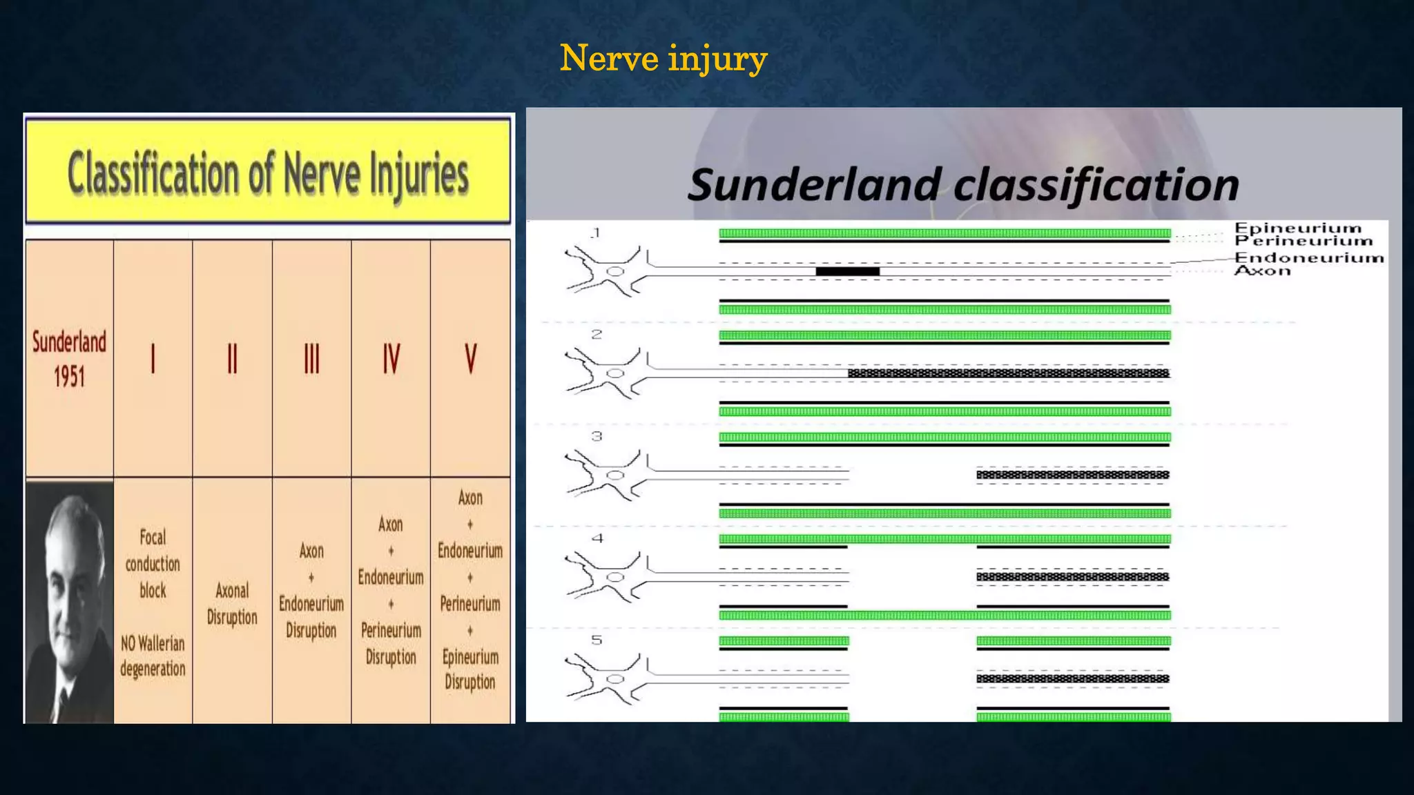 Iatrogenic facial nerve injury | PPTX