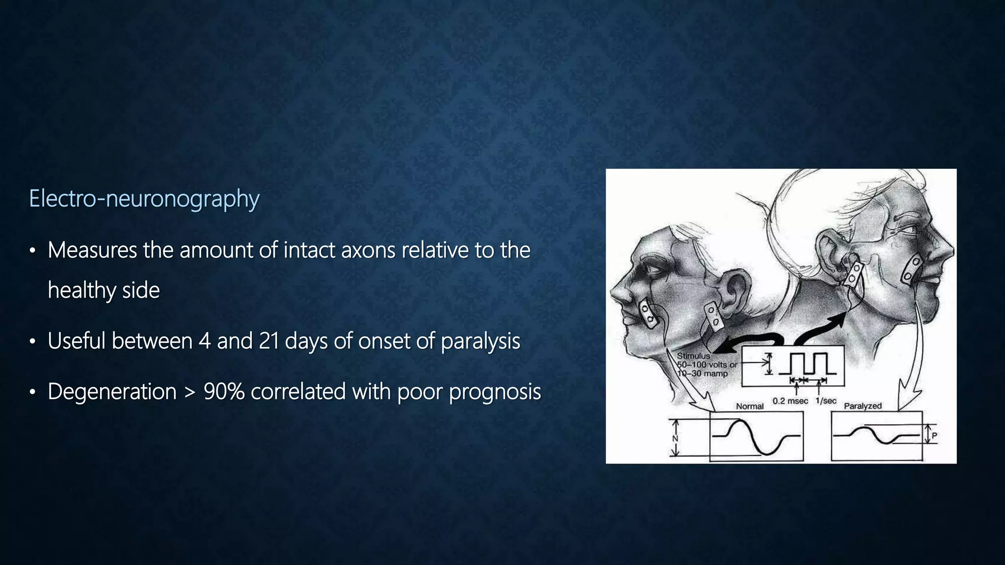 Iatrogenic facial nerve injury | PPTX