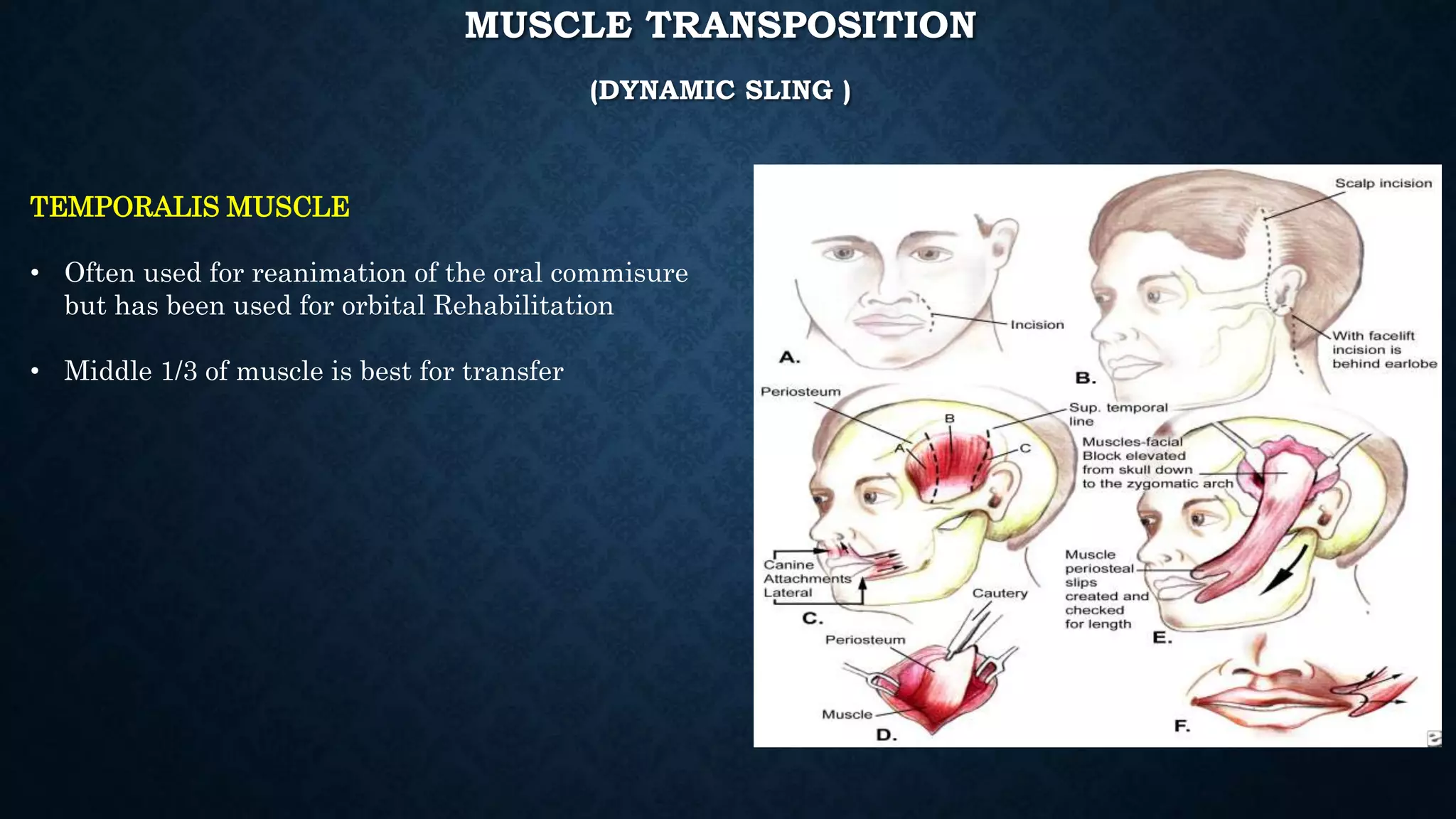 Iatrogenic facial nerve injury | PPTX