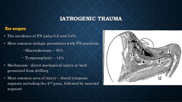 Iatrogenic facial nerve injury