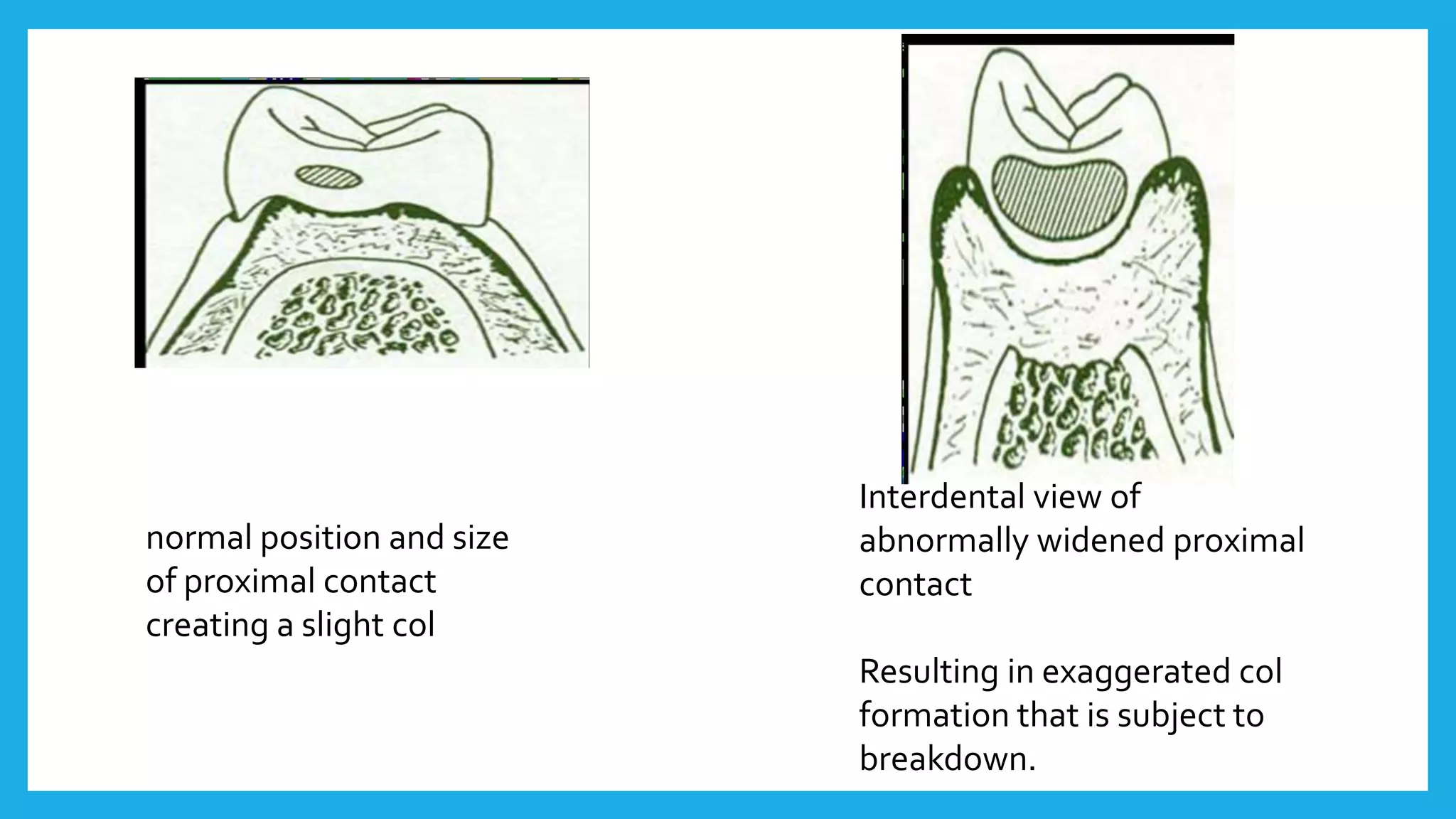 Iatrogenic factors affecting Periodontium | PPTX