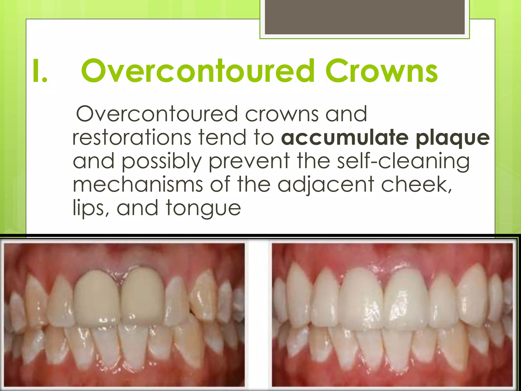 Iatrogenic factors in periodontal disease | PPTX