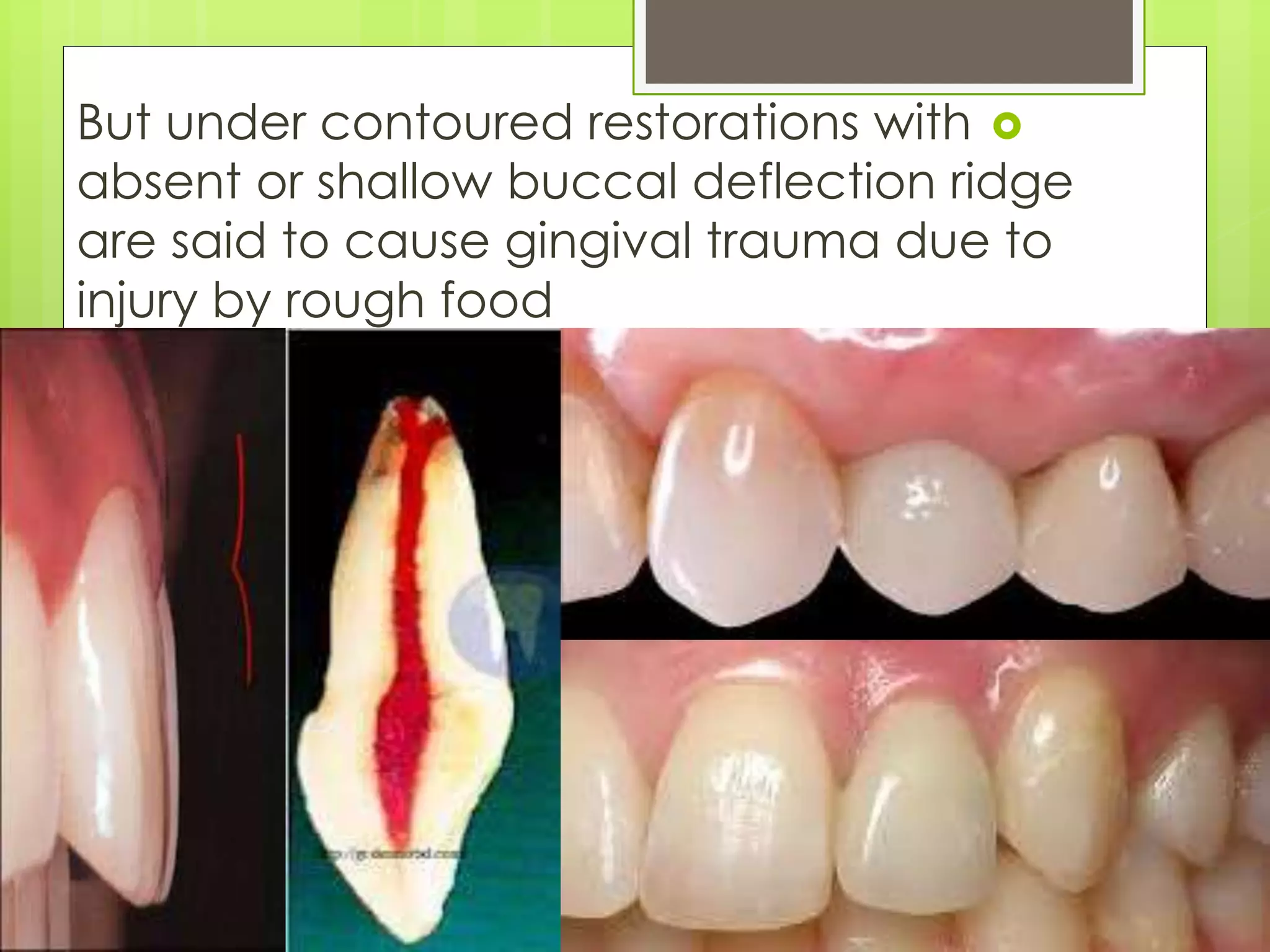 Iatrogenic factors in periodontal disease | PPTX