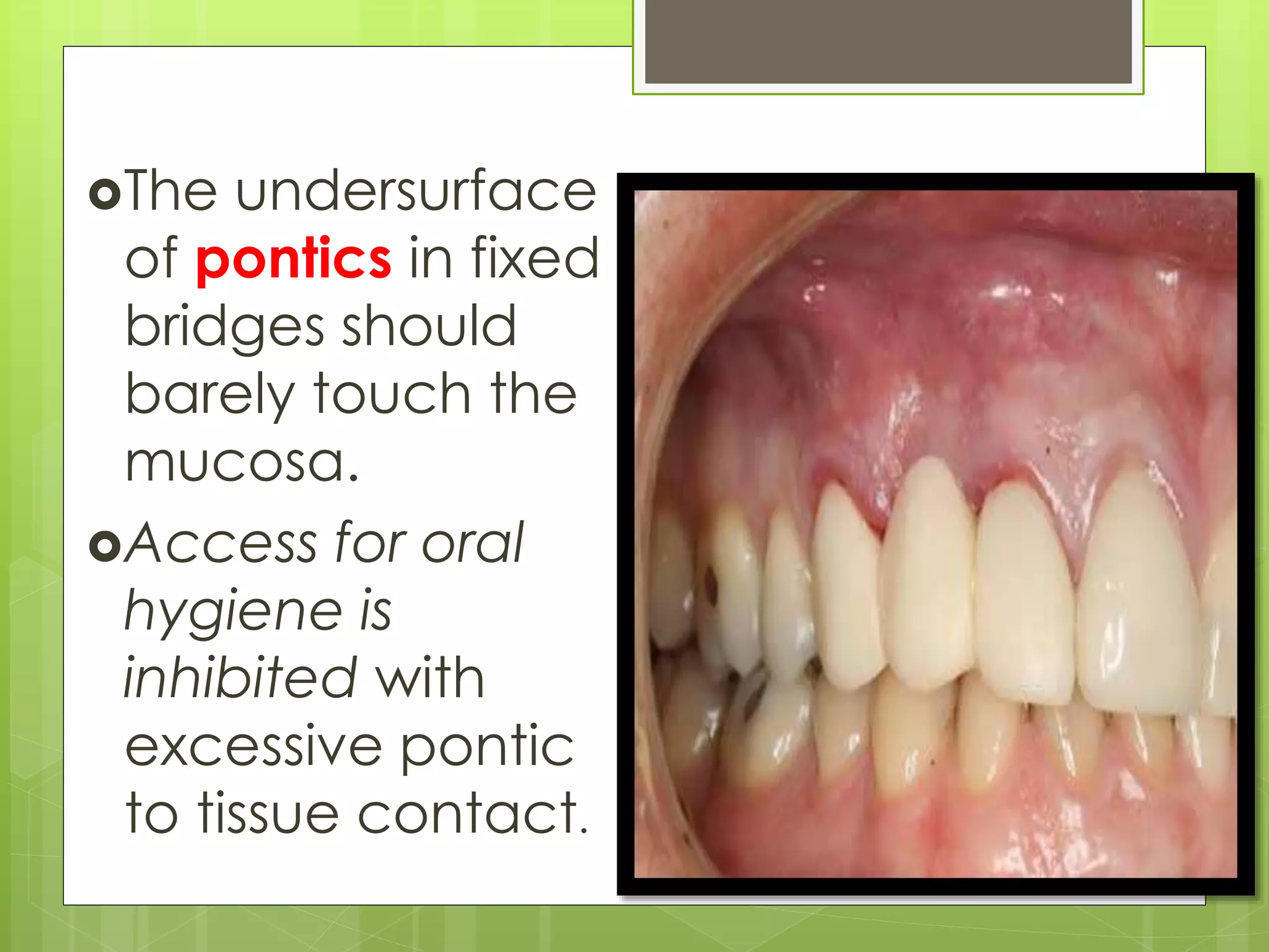 Iatrogenic factors in periodontal disease | PPTX