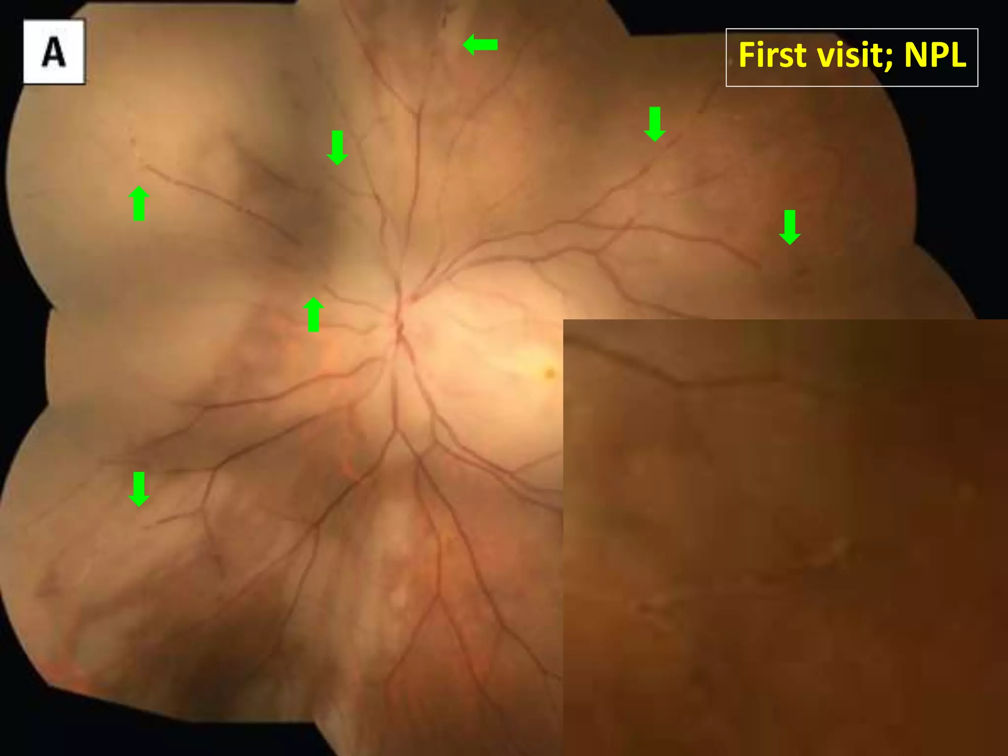 Iatrogenic occlusion of the ophthalmic artery after cosmetic facial ...