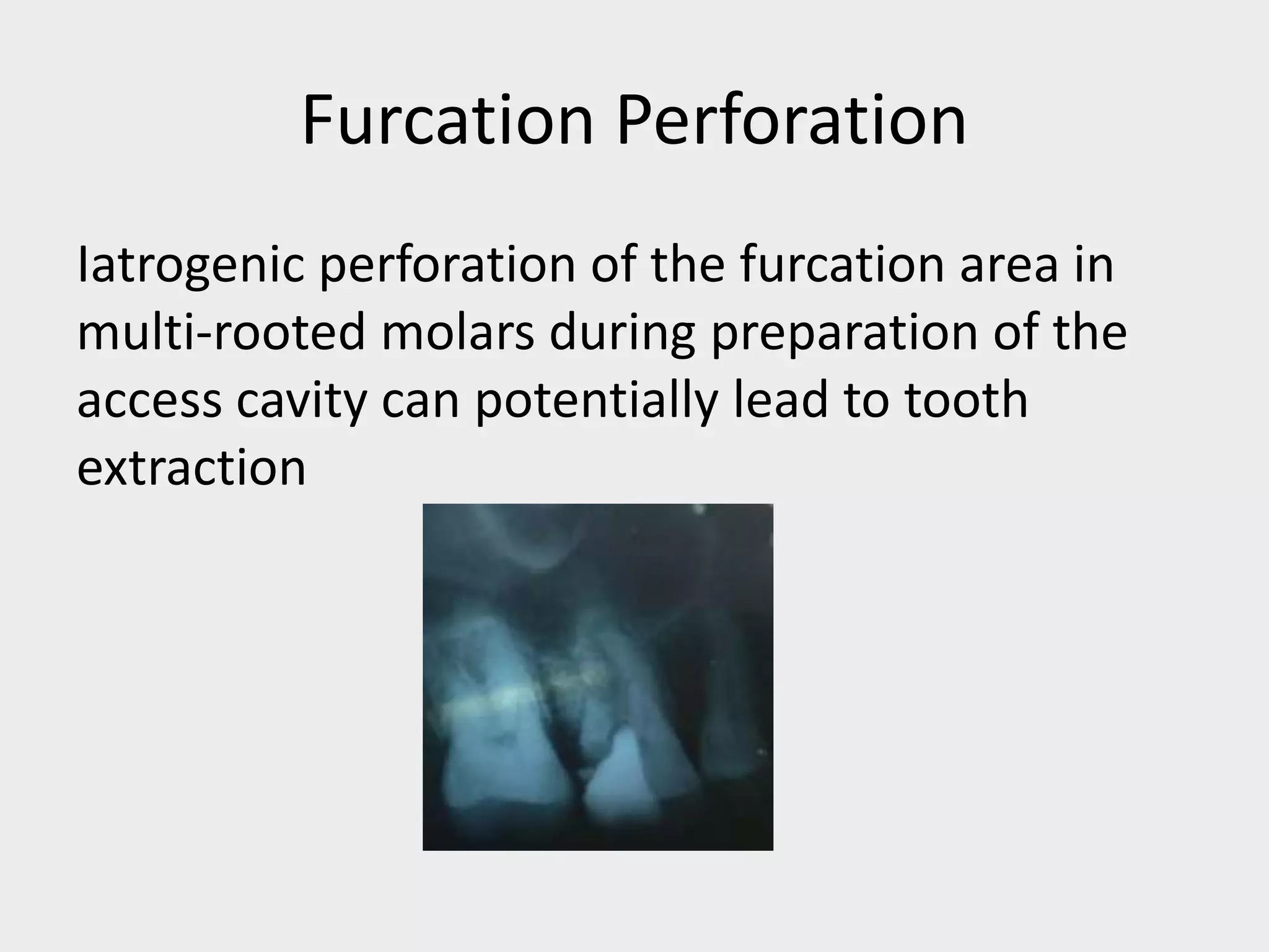 Iatrogenic Perforation- A guide to fixing the hole in your patient's ...