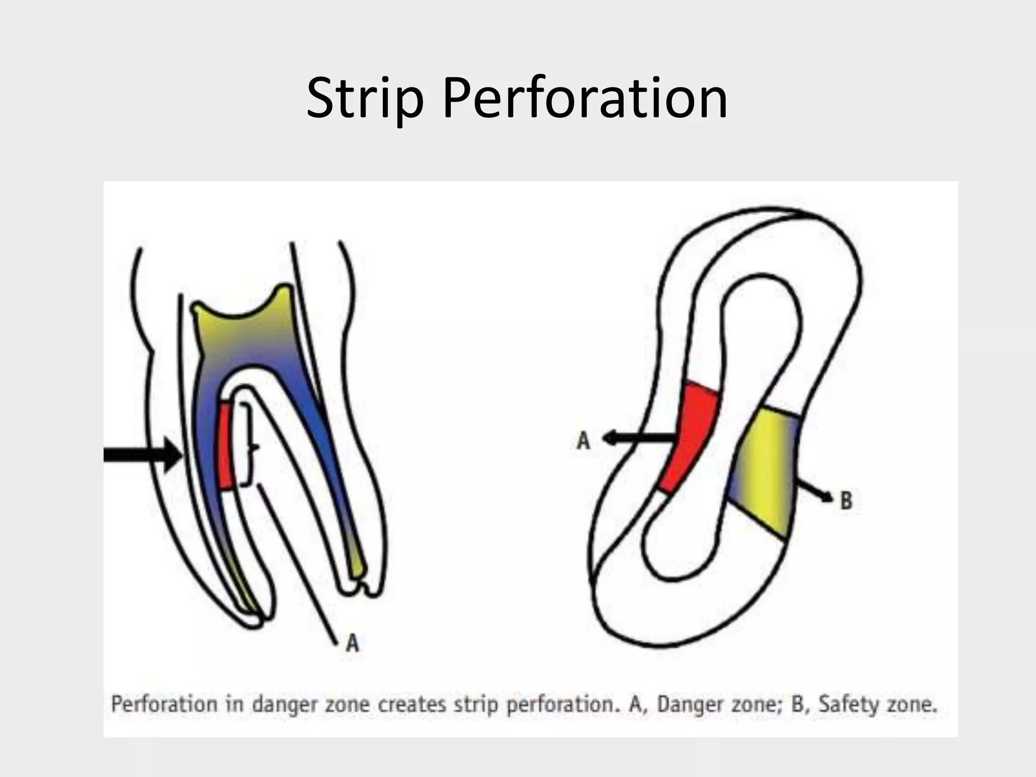 Iatrogenic Perforation- A guide to fixing the hole in your patient's ...
