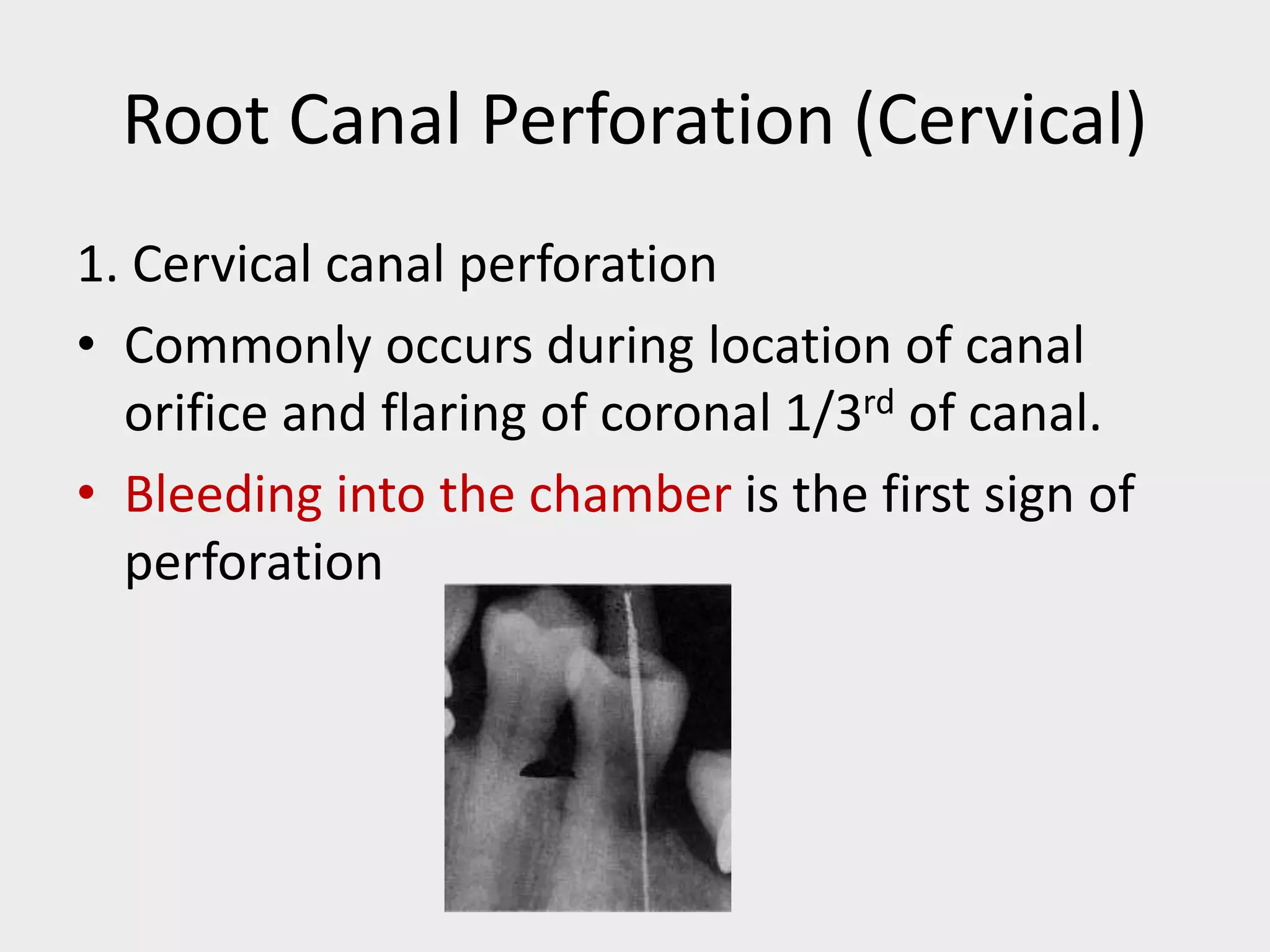 Iatrogenic Perforation- A guide to fixing the hole in your patient's ...