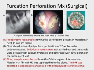 Iatrogenic Perforation- A guide to fixing the hole in your patient's ...