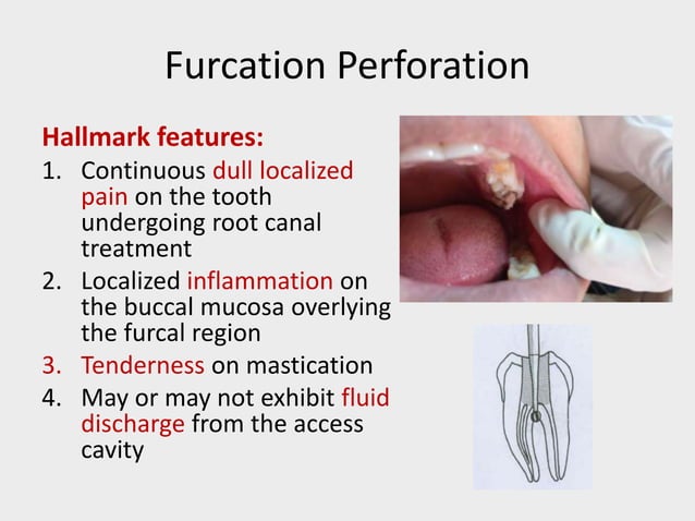 Iatrogenic Perforation- A guide to fixing the hole in your patient's tooth