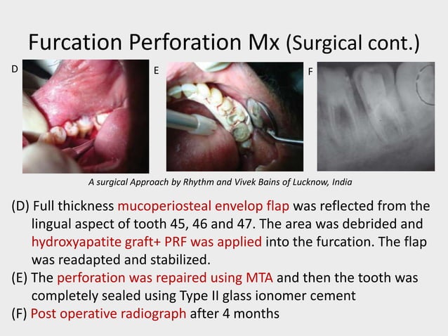Iatrogenic Perforation- A guide to fixing the hole in your patient's tooth