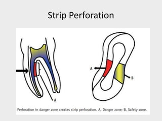 Iatrogenic Perforation- A guide to fixing the hole in your patient's ...