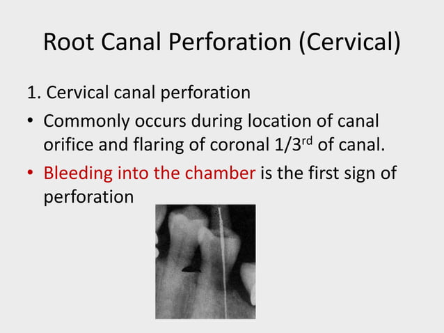 Iatrogenic Perforation- A guide to fixing the hole in your patient's tooth