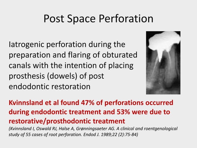 Iatrogenic Perforation- A guide to fixing the hole in your patient's tooth