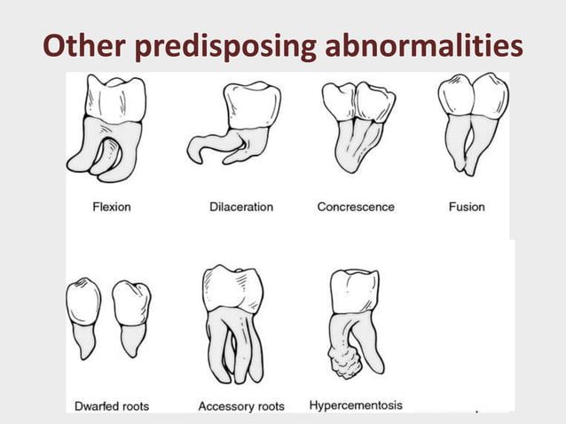 Iatrogenic Perforation- A guide to fixing the hole in your patient's tooth