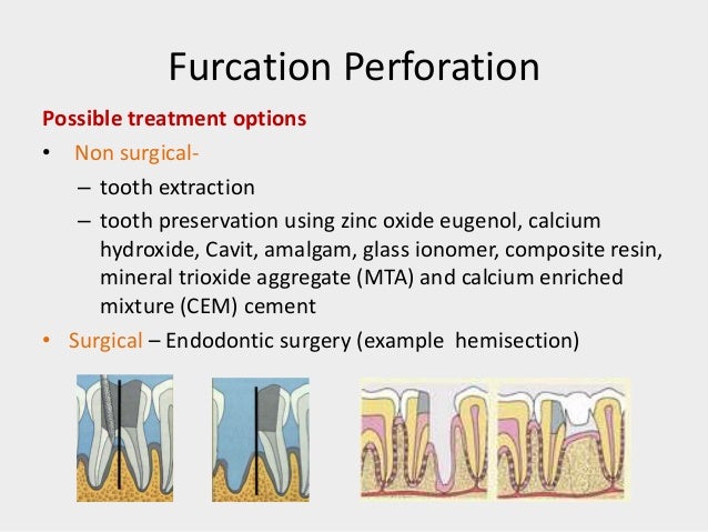 Iatrogenic Perforation- A guide to fixing the hole in your patient's