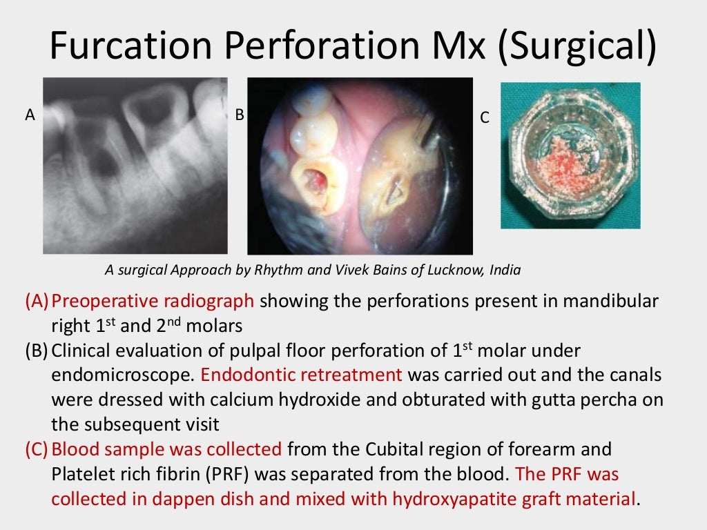 Iatrogenic Perforation- A guide to fixing the hole in your patient's