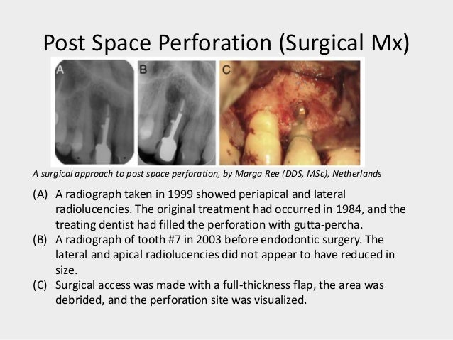 Iatrogenic Perforation- A guide to fixing the hole in your patient's