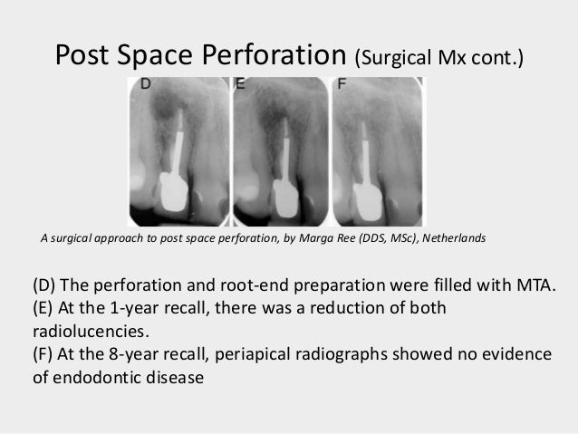 Iatrogenic Perforation- A guide to fixing the hole in your patient's