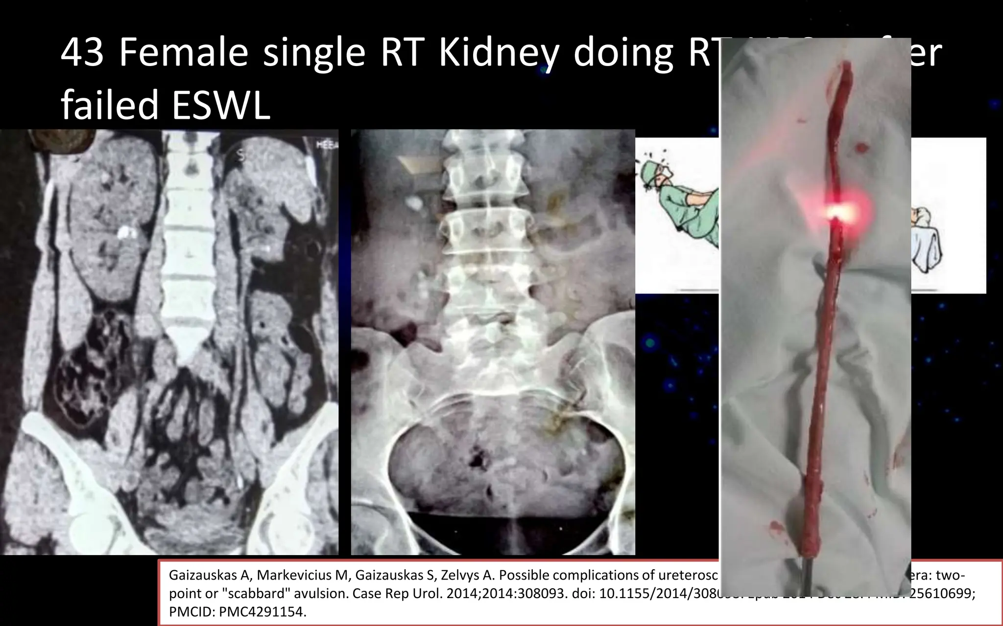 iatrogenic ureteral injuries conrad.pptx