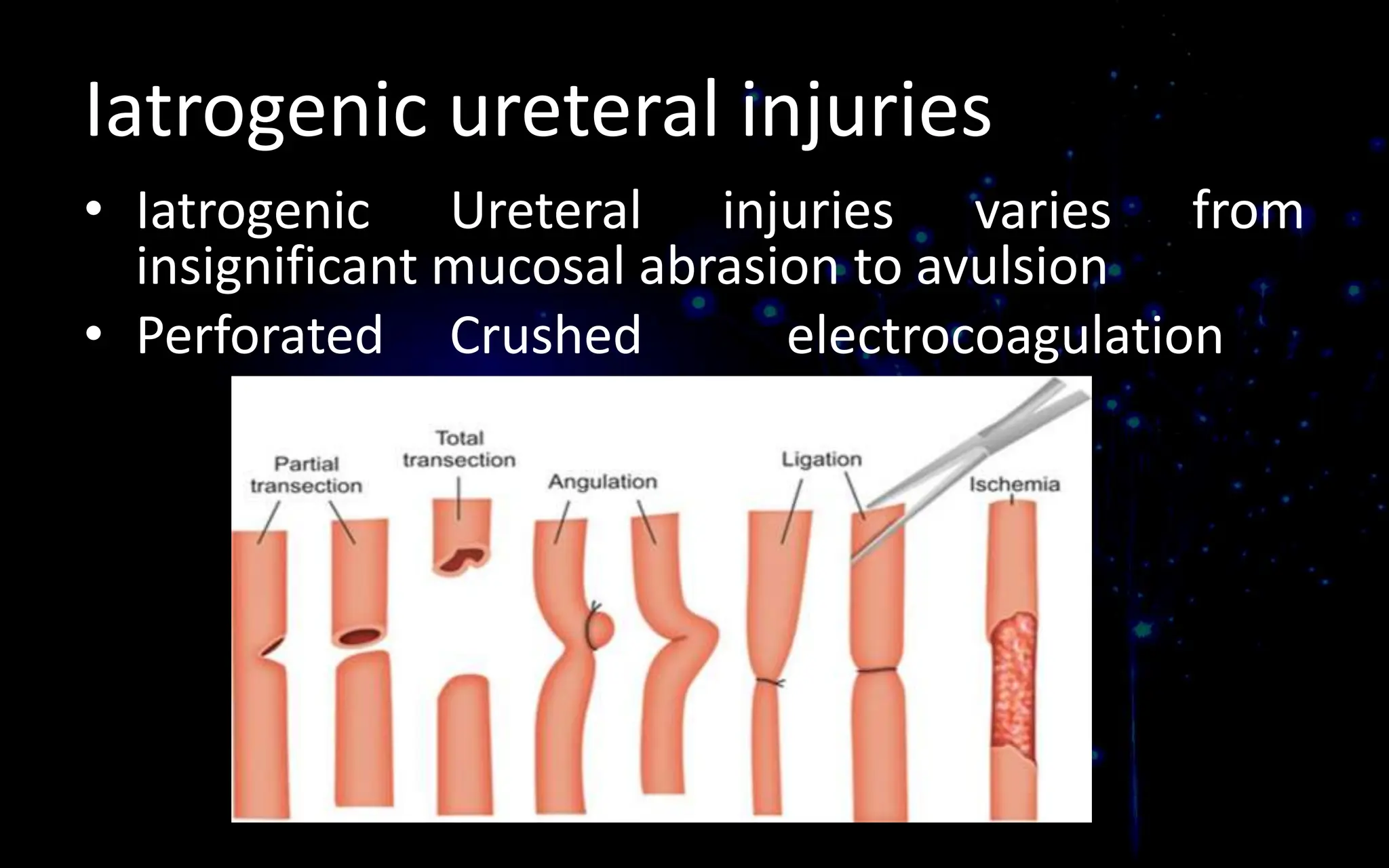 iatrogenic ureteral injuries conrad.pptx