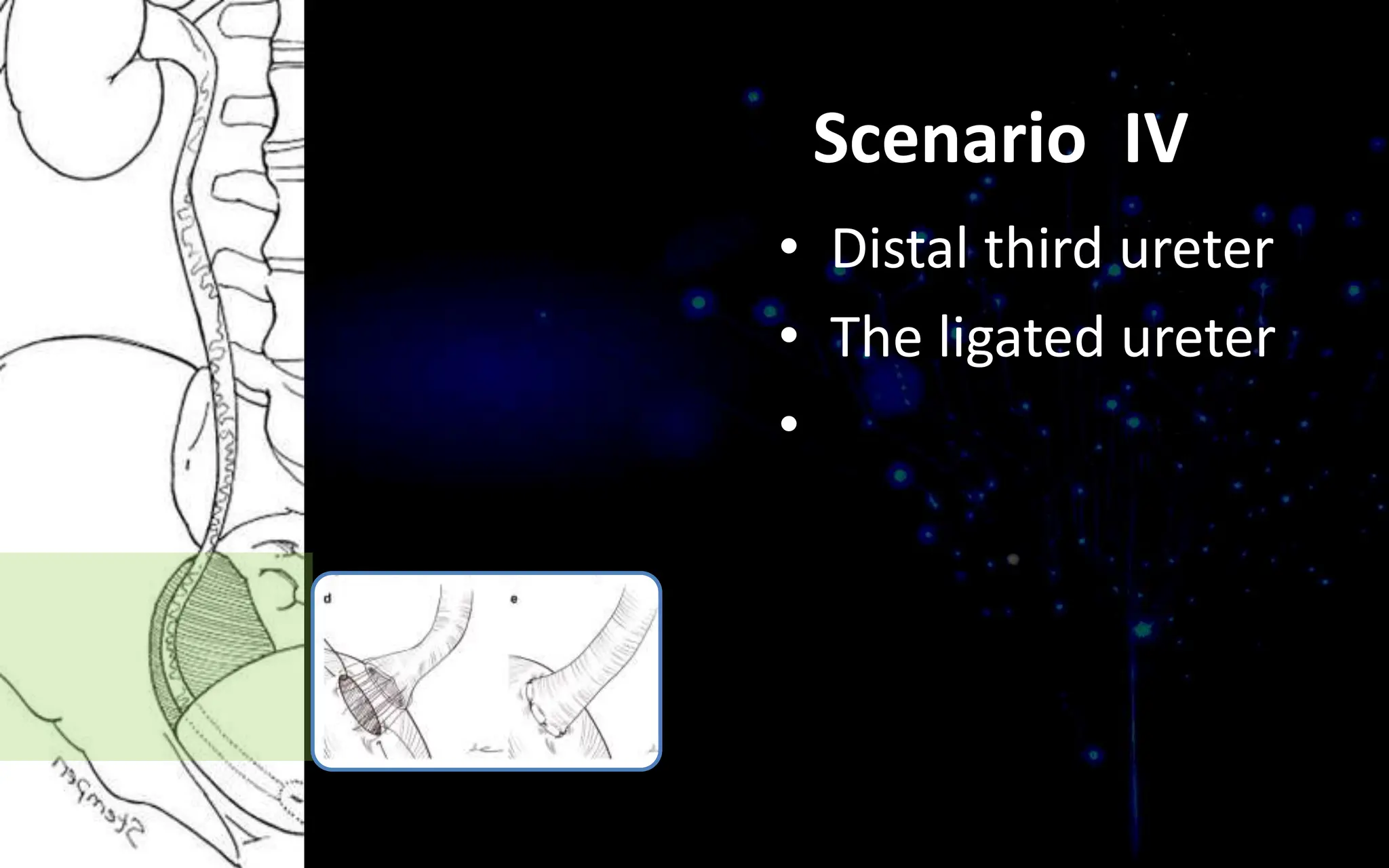 iatrogenic ureteral injuries conrad.pptx