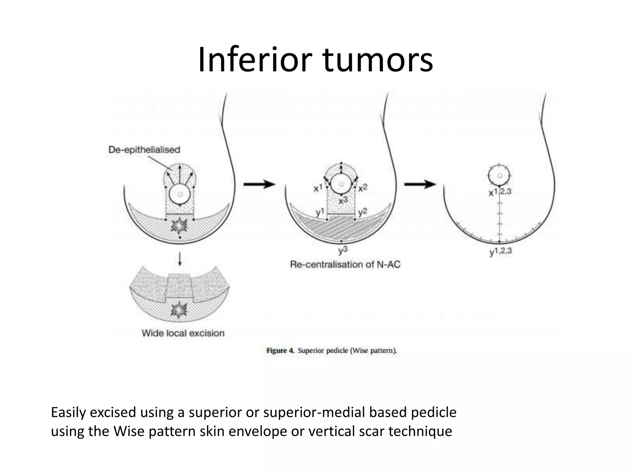 ONCOPLASTIC_BREAST_SURGERY.pptx