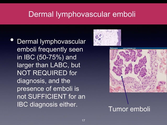 Inflammatory Breast Cancer (IBC) Information | PPTX | Cancer | Diseases ...