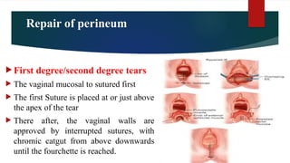 Injuries to birth canal- Obstetrics and gynaecological nursing | PPTX