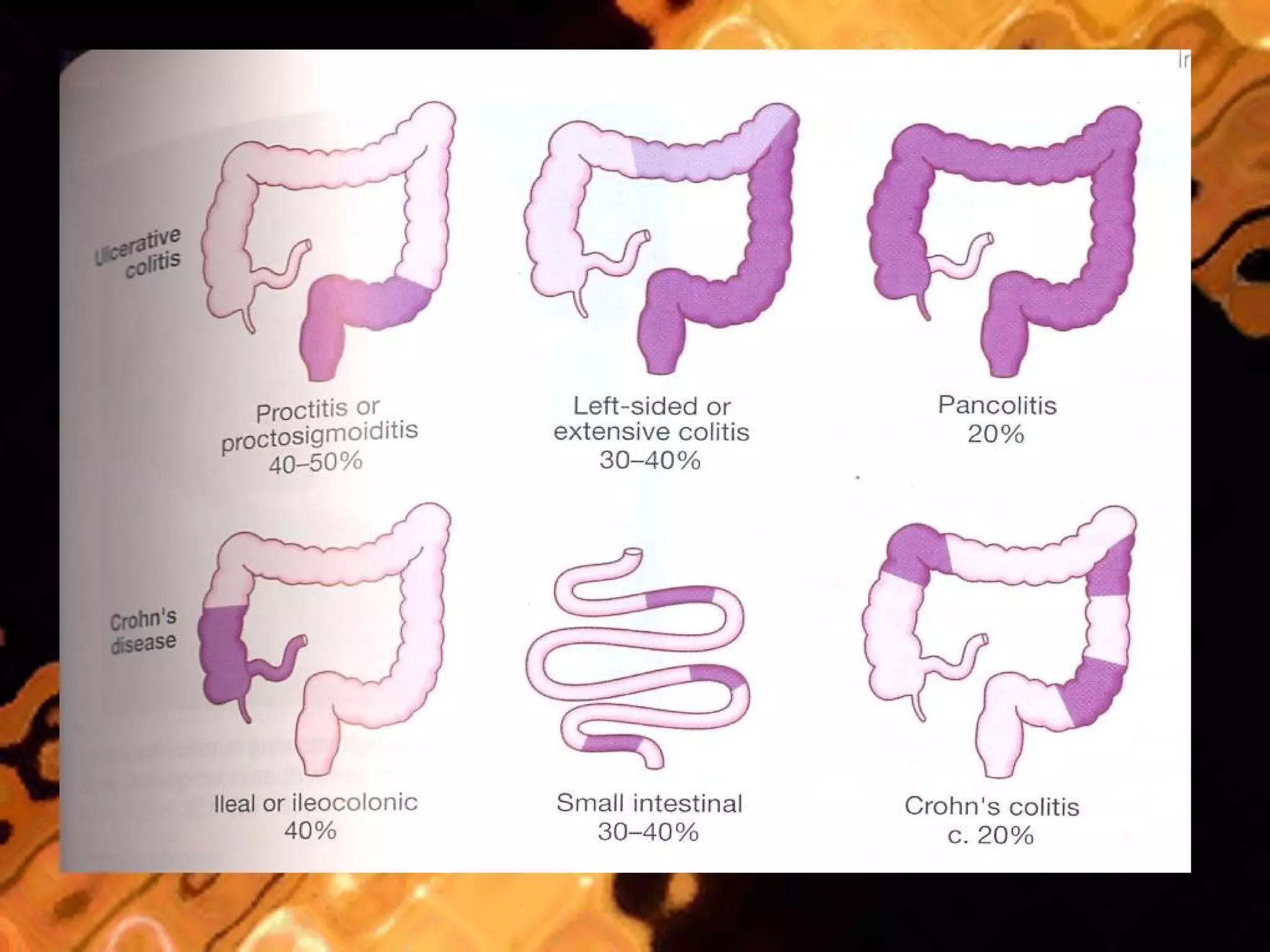 INFLAMMATORY BOWEL DISEASE | PPT