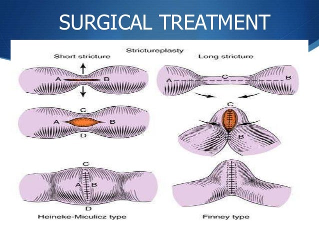 Management of Inflammatory Bowel Disease