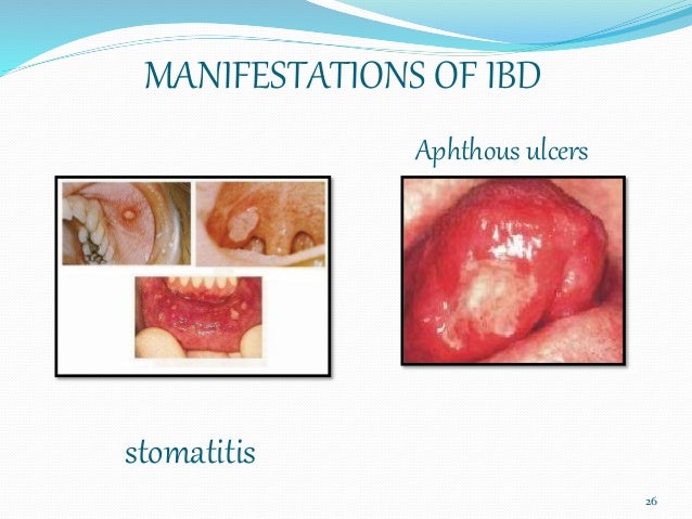 Inflammatory Bowel Disease