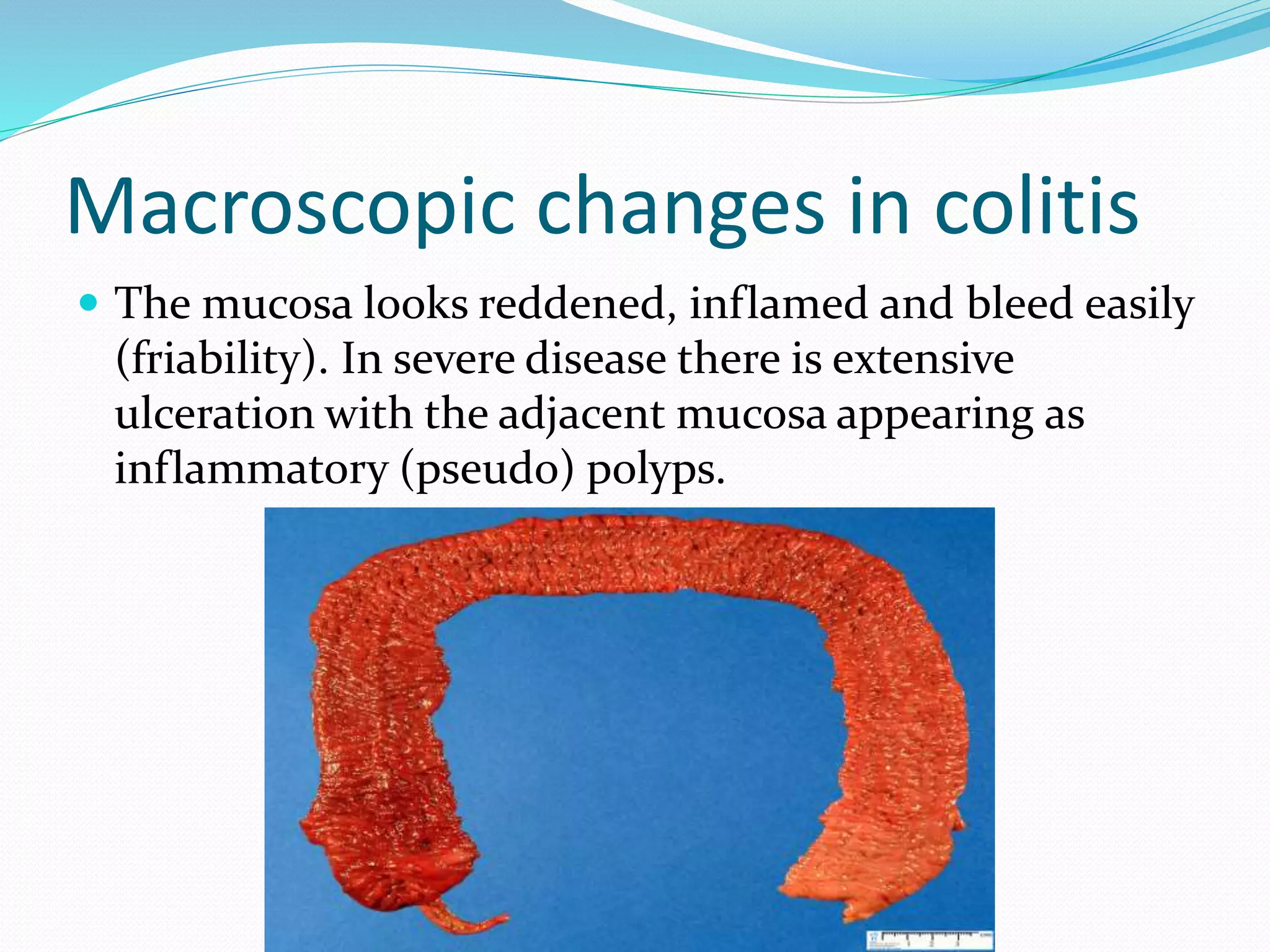 inflammatory bowel disease (IBD) | PPTX