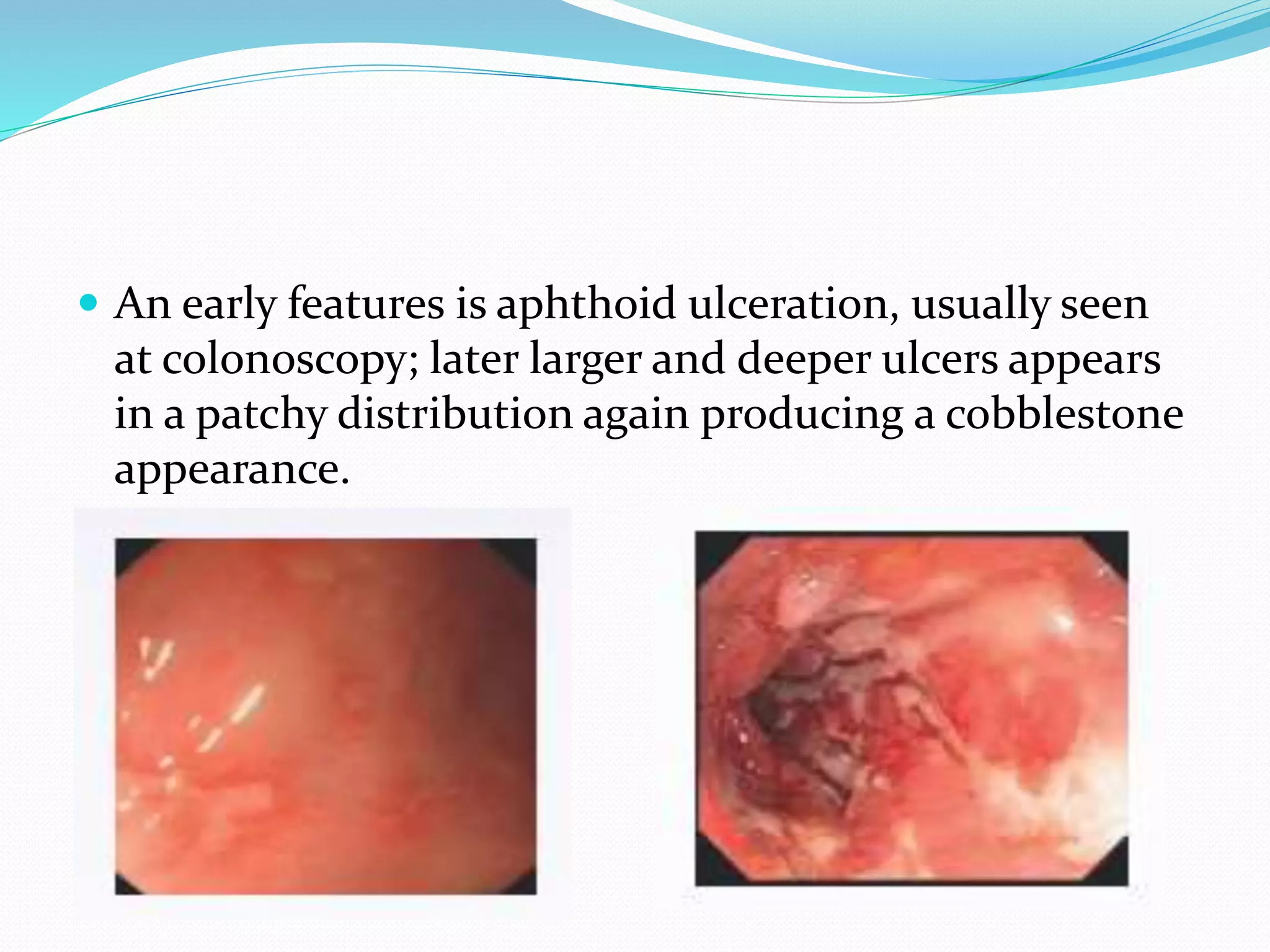 inflammatory bowel disease (IBD) | PPTX
