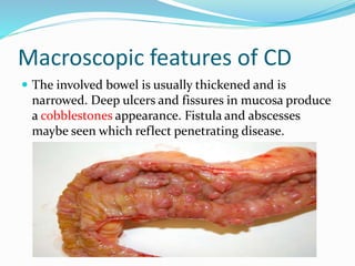 inflammatory bowel disease (IBD) | PPTX