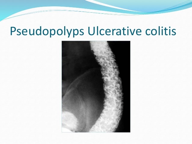 inflammatory bowel disease (IBD)
