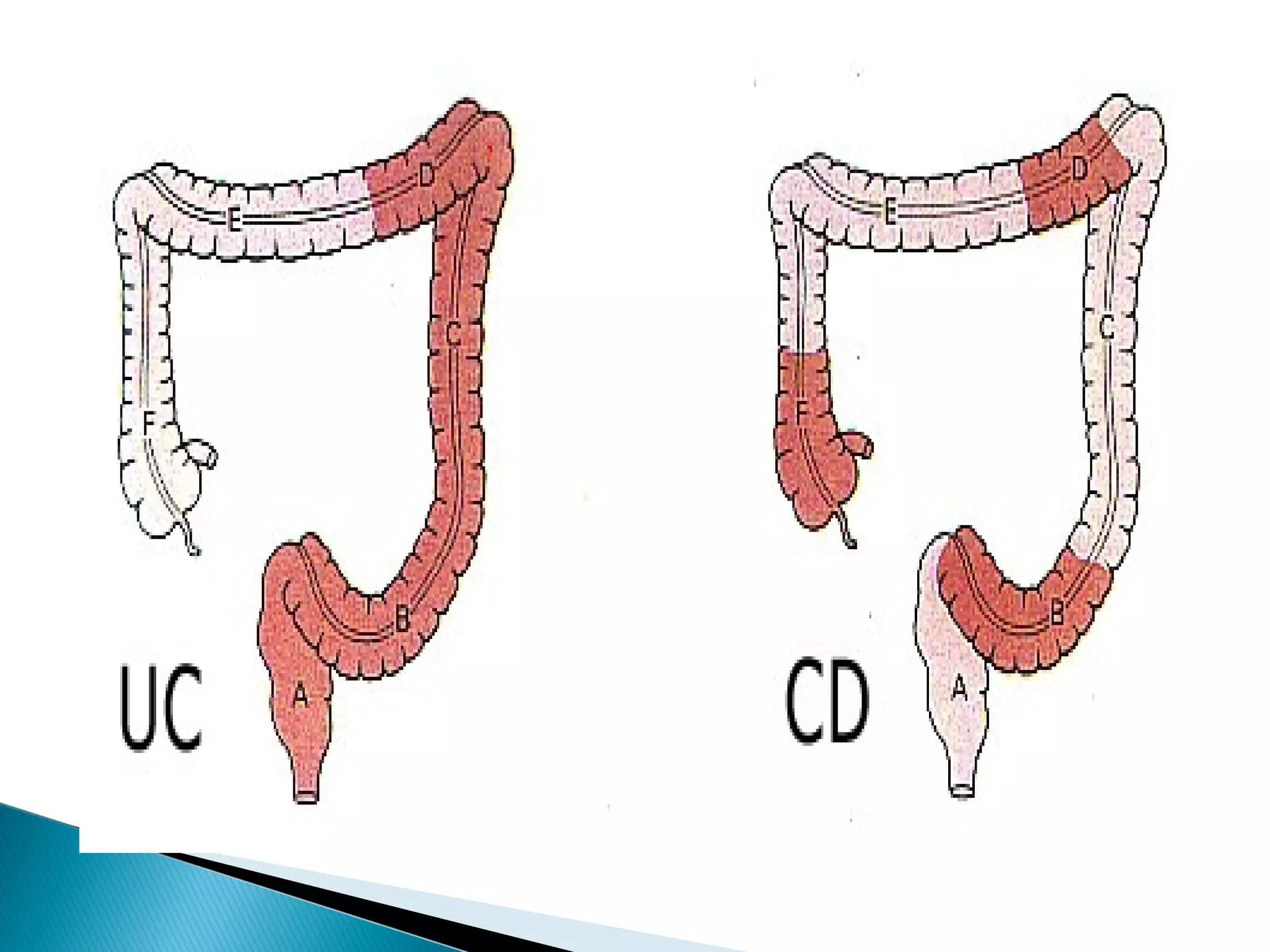 Inflamatory bowel disease, IBD | PPT