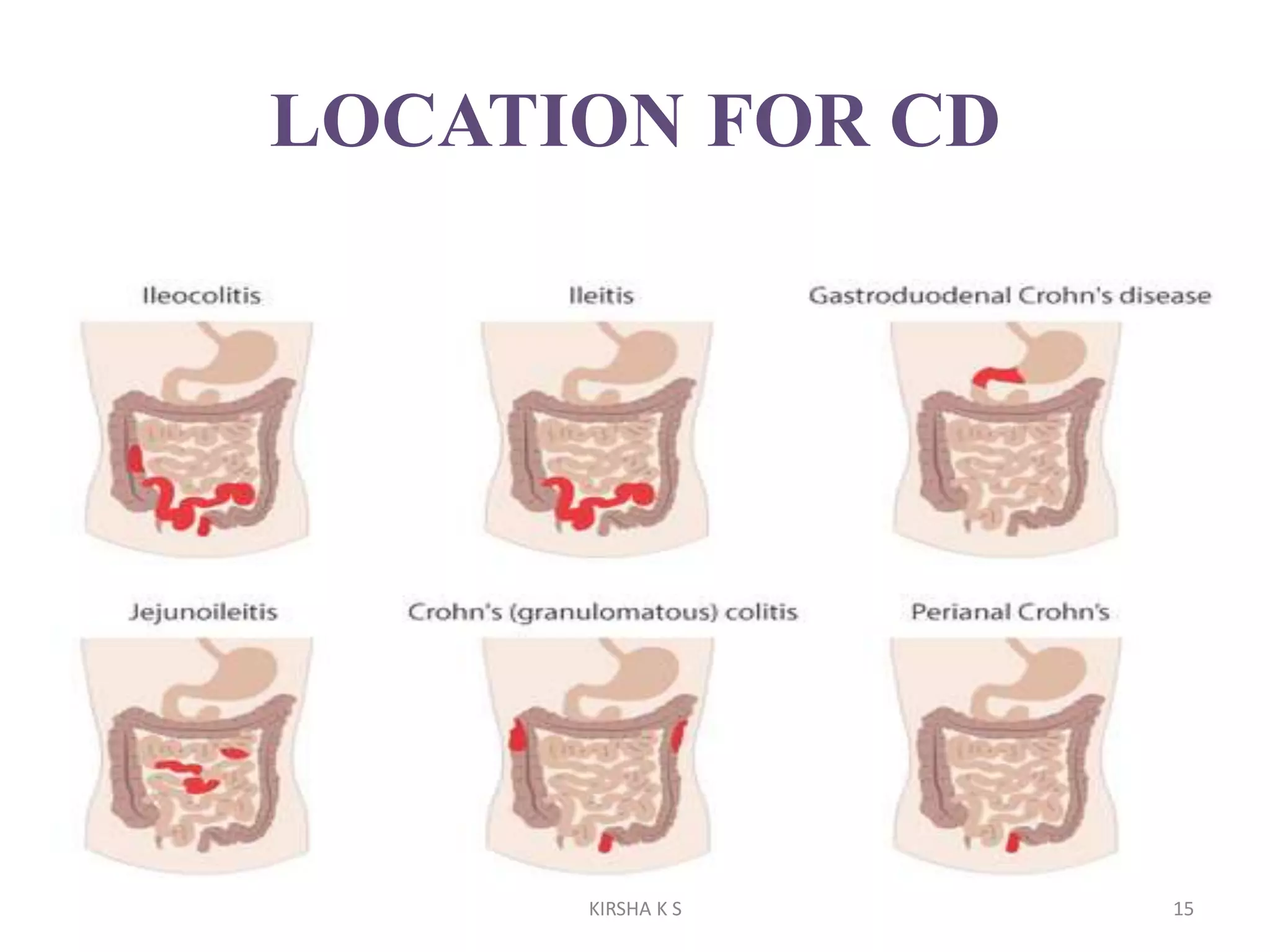 Inflammatory Bowel Disease | PDF | Digestive Disorders | Diseases and ...