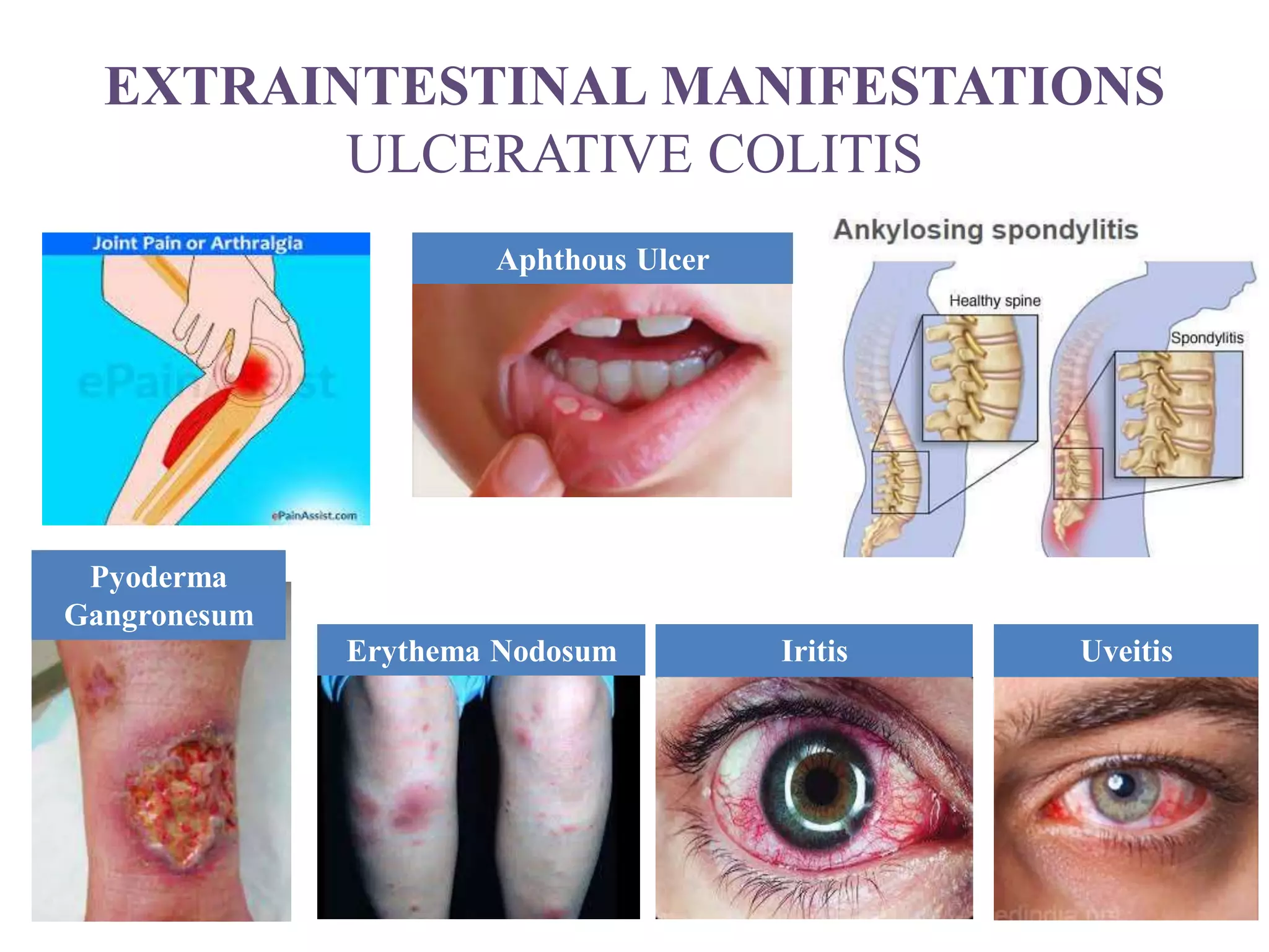 Inflammatory Bowel Disease | PDF
