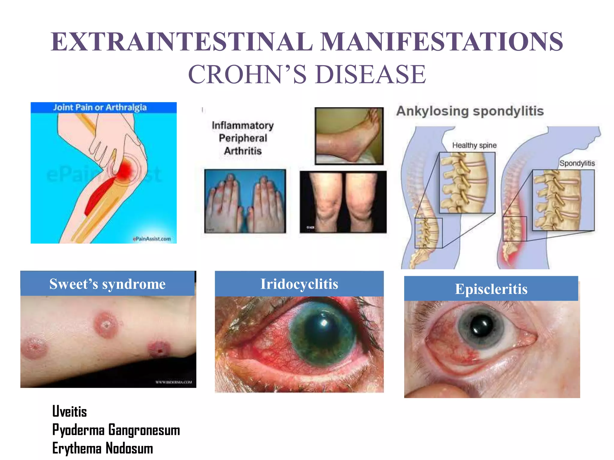Inflammatory Bowel Disease | PDF