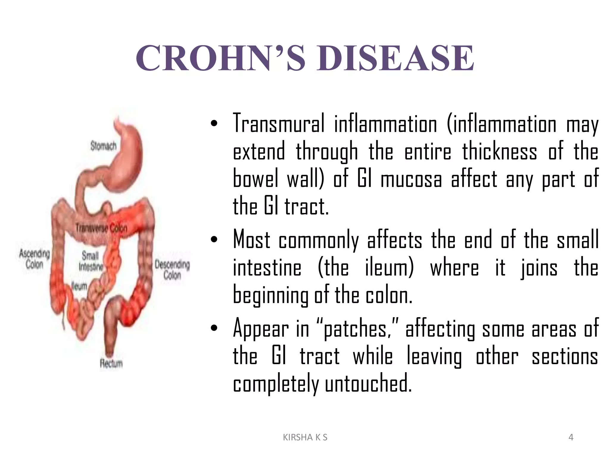 Inflammatory Bowel Disease | PDF