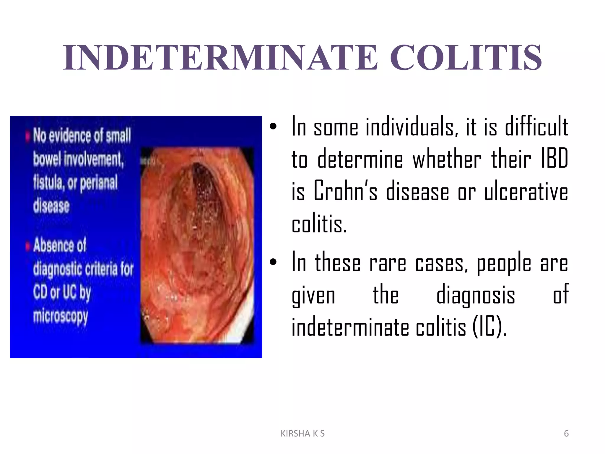 Inflammatory Bowel Disease | PDF