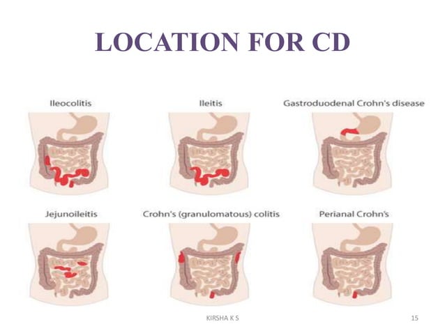 Inflammatory Bowel Disease | PDF | Digestive Disorders | Diseases and ...