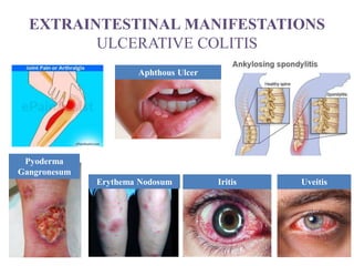 Inflammatory Bowel Disease | PDF