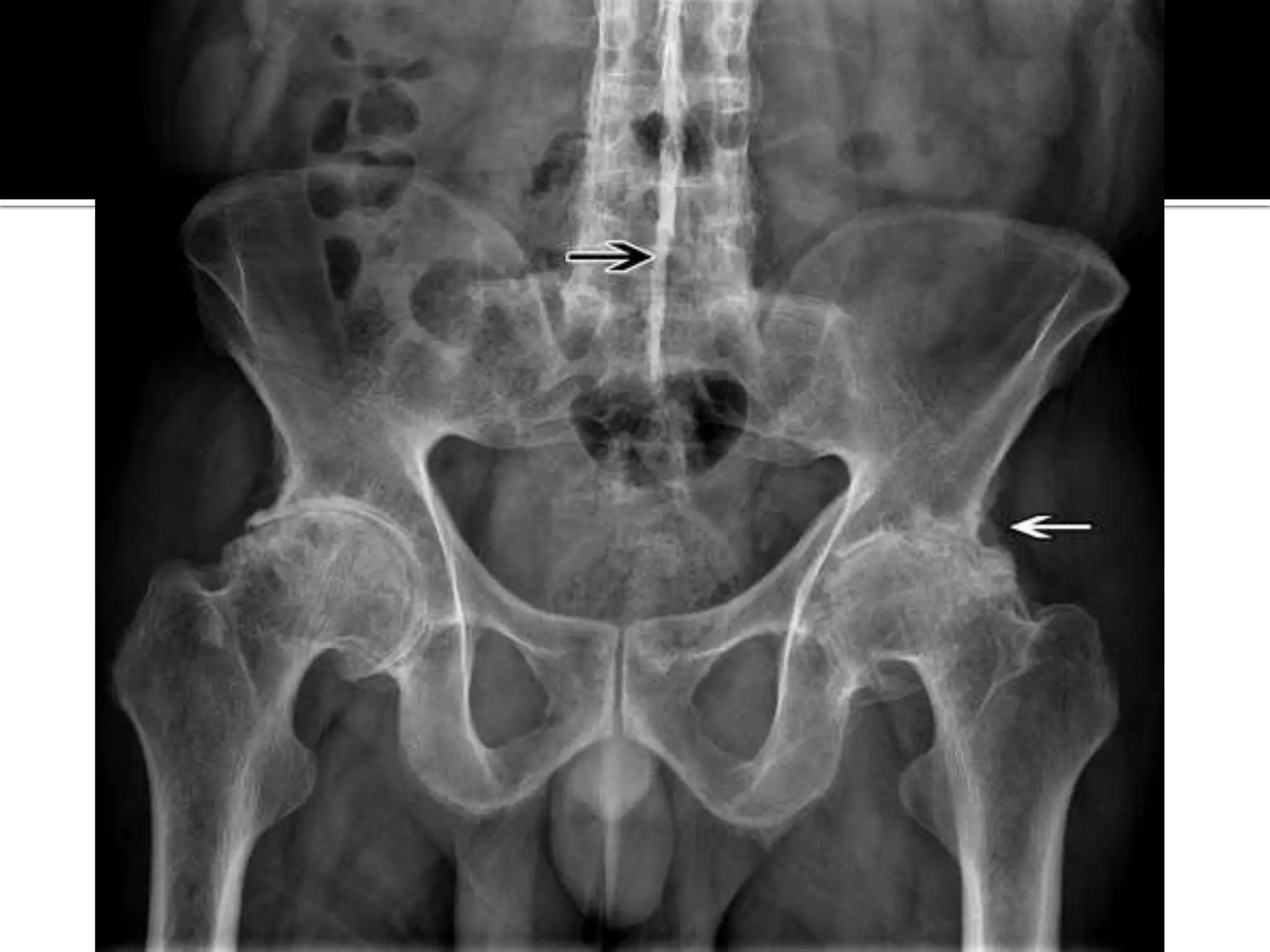 Extraintestinal Manifestations OF IBD Inflammatory Bowel Disease : A ...