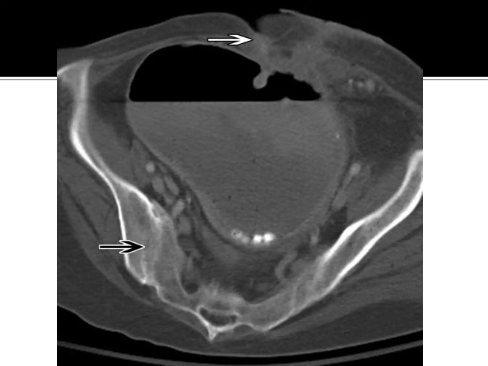 Extraintestinal Manifestations OF IBD Inflammatory Bowel Disease : A ...